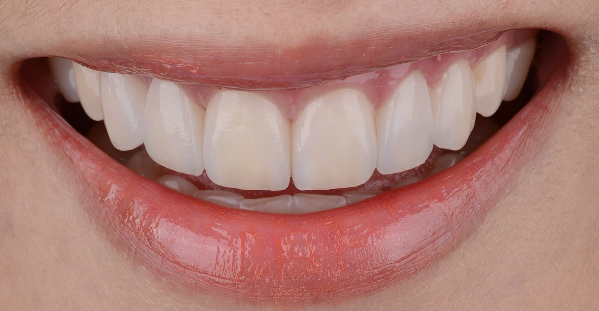 #1 Best Invisalign Treatment in UK - Carholme Dental Group